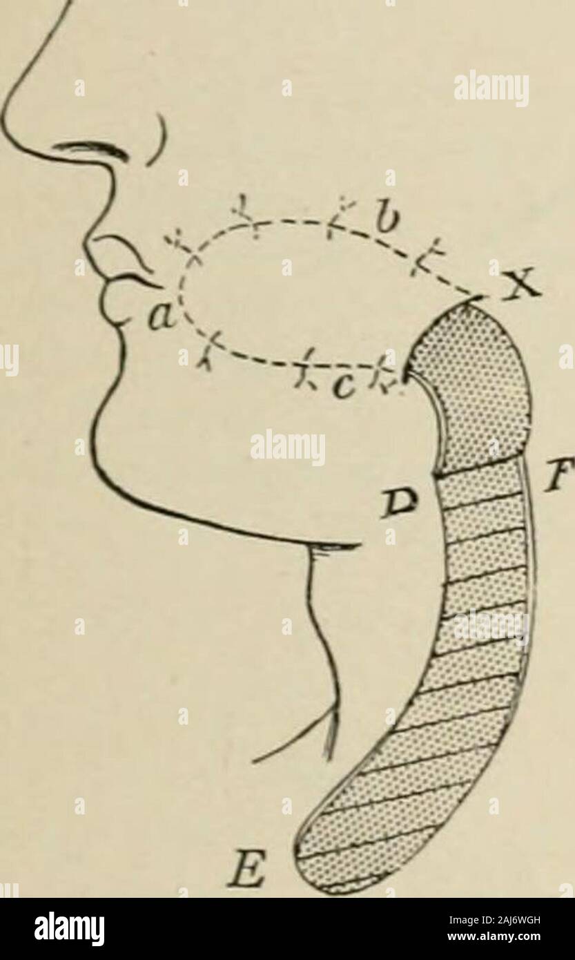 Plastic surgery; its principles and practice . eck with the pedicle ...