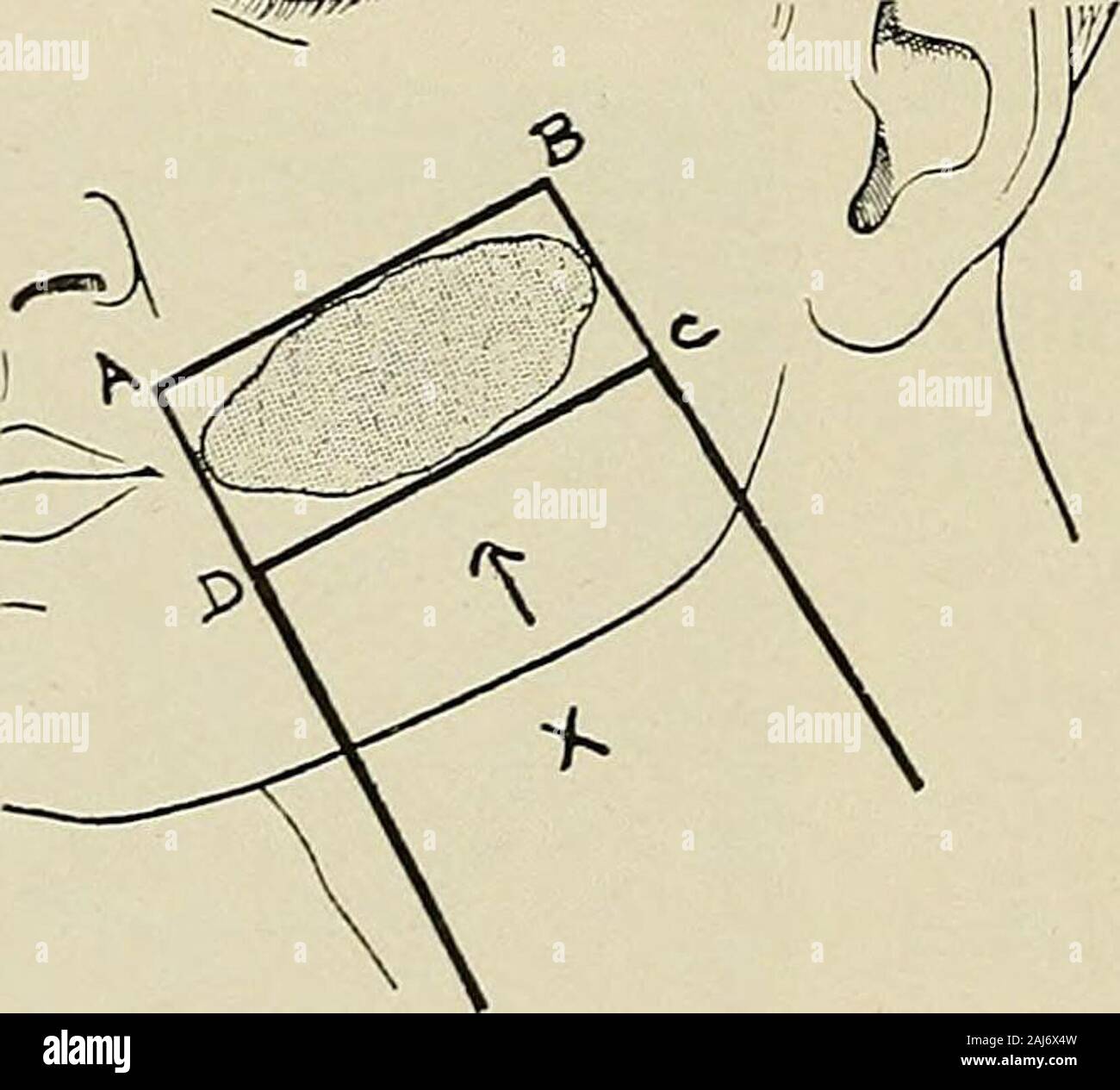 Burn scar contracture hi-res stock photography and images - Alamy