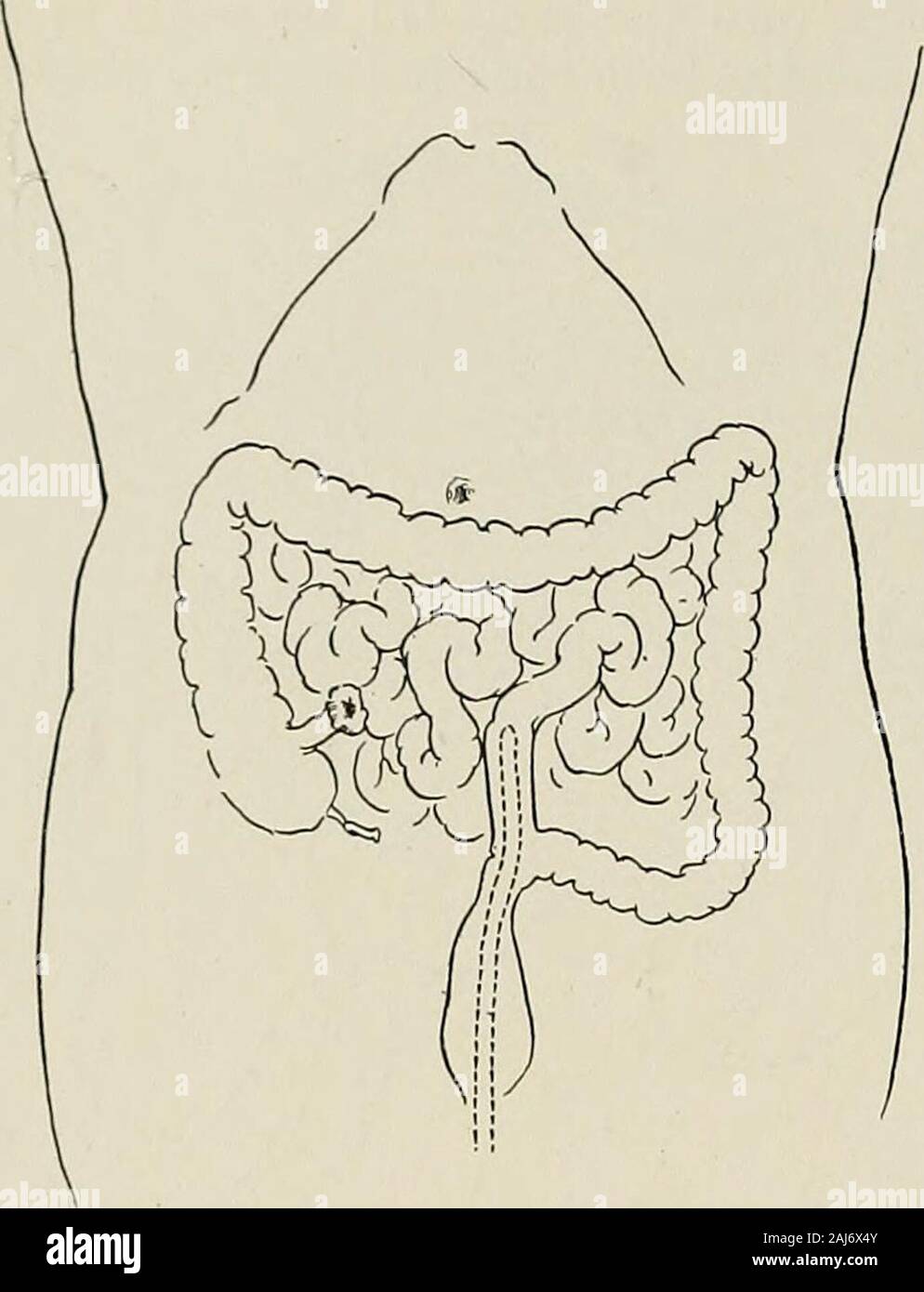Side to side anastomosis hi-res stock photography and images - Alamy