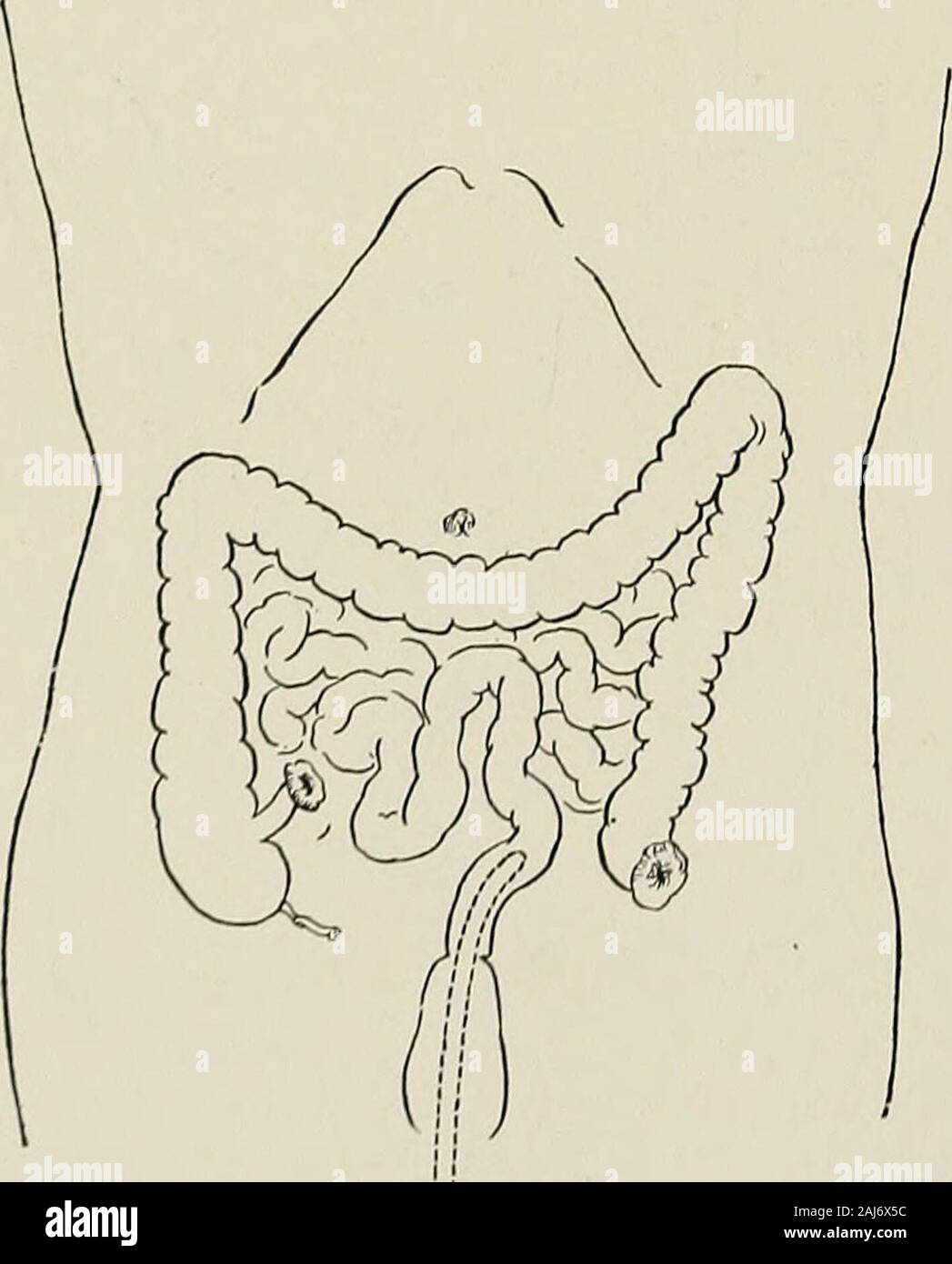 Intestinal anastomosis hi-res stock photography and images - Alamy