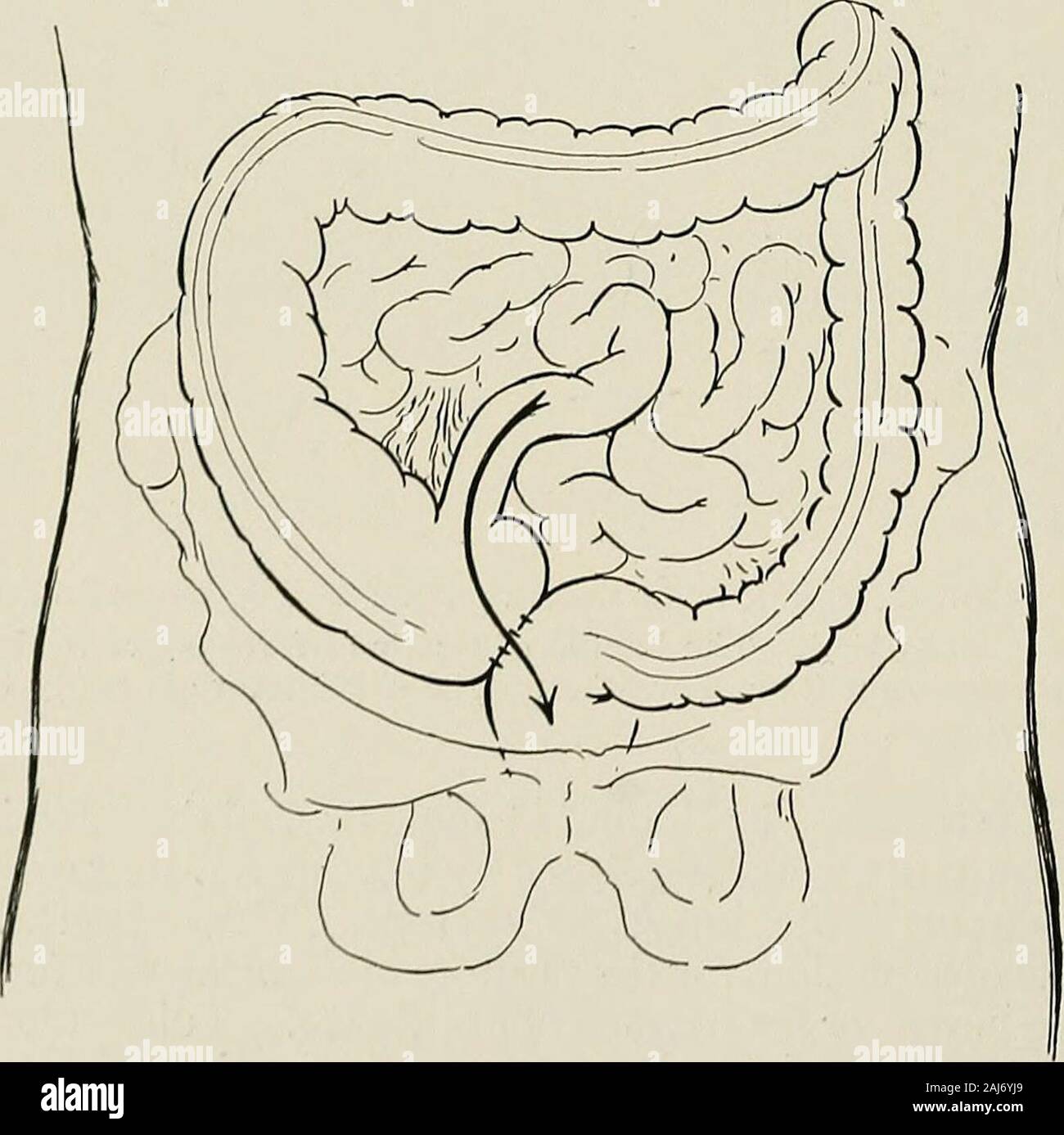 Anastomosis intestinal hi-res stock photography and images - Alamy