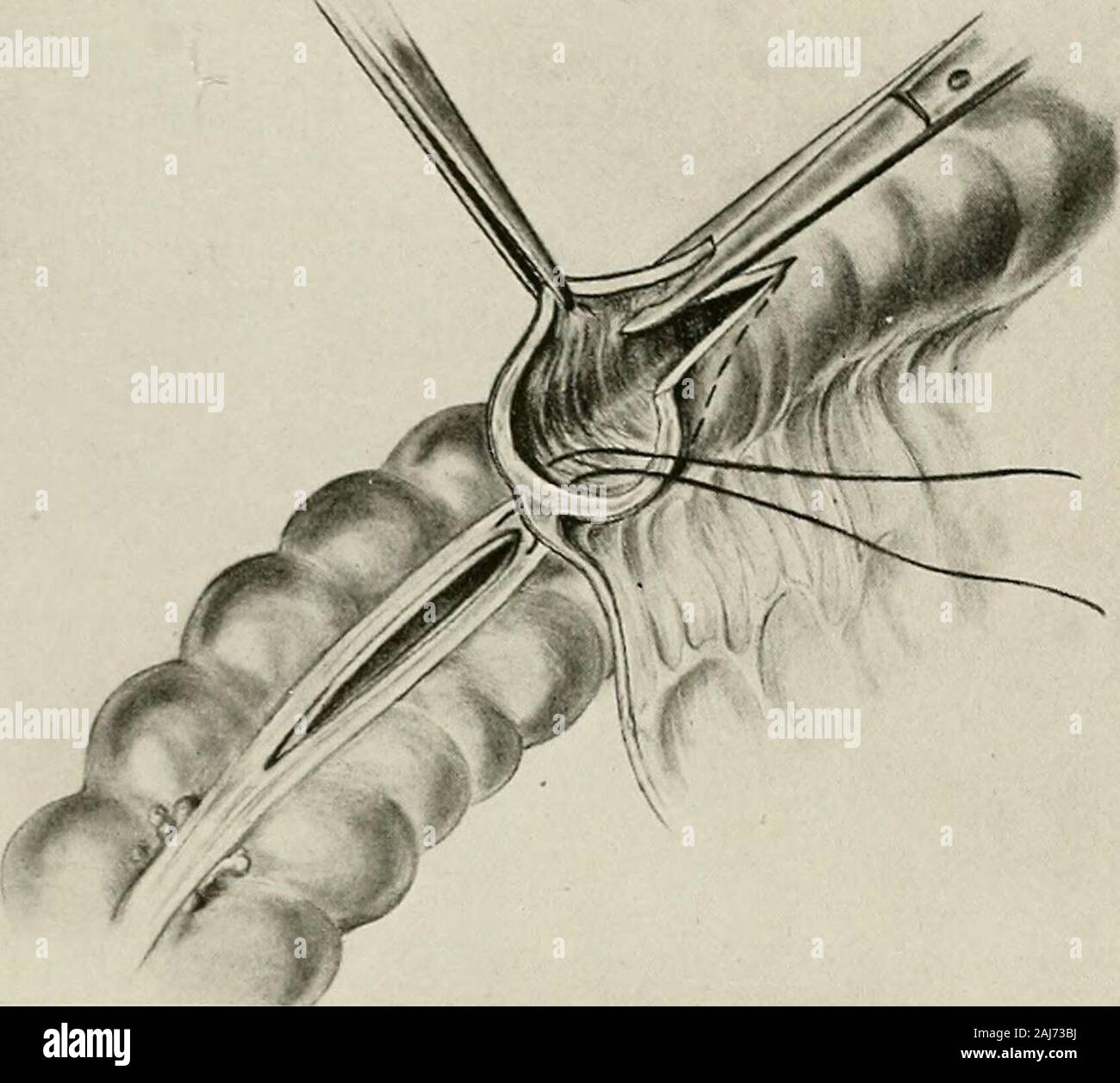 Bowel resection hi-res stock photography and images - Alamy