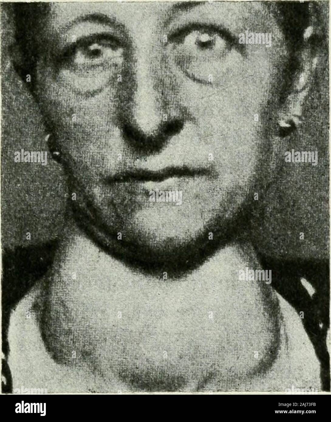 Graves' disease eye hi-res stock photography and images - Alamy