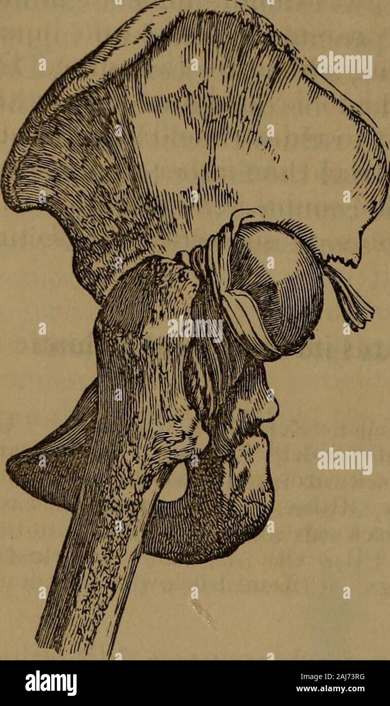 A practical treatise on fractures and dislocations . dislocated into ...