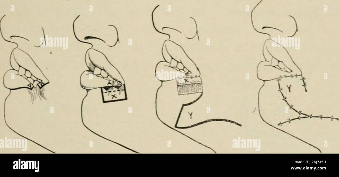 Plastic surgery; its principles and practice . Fig. 628.—Operation for ...