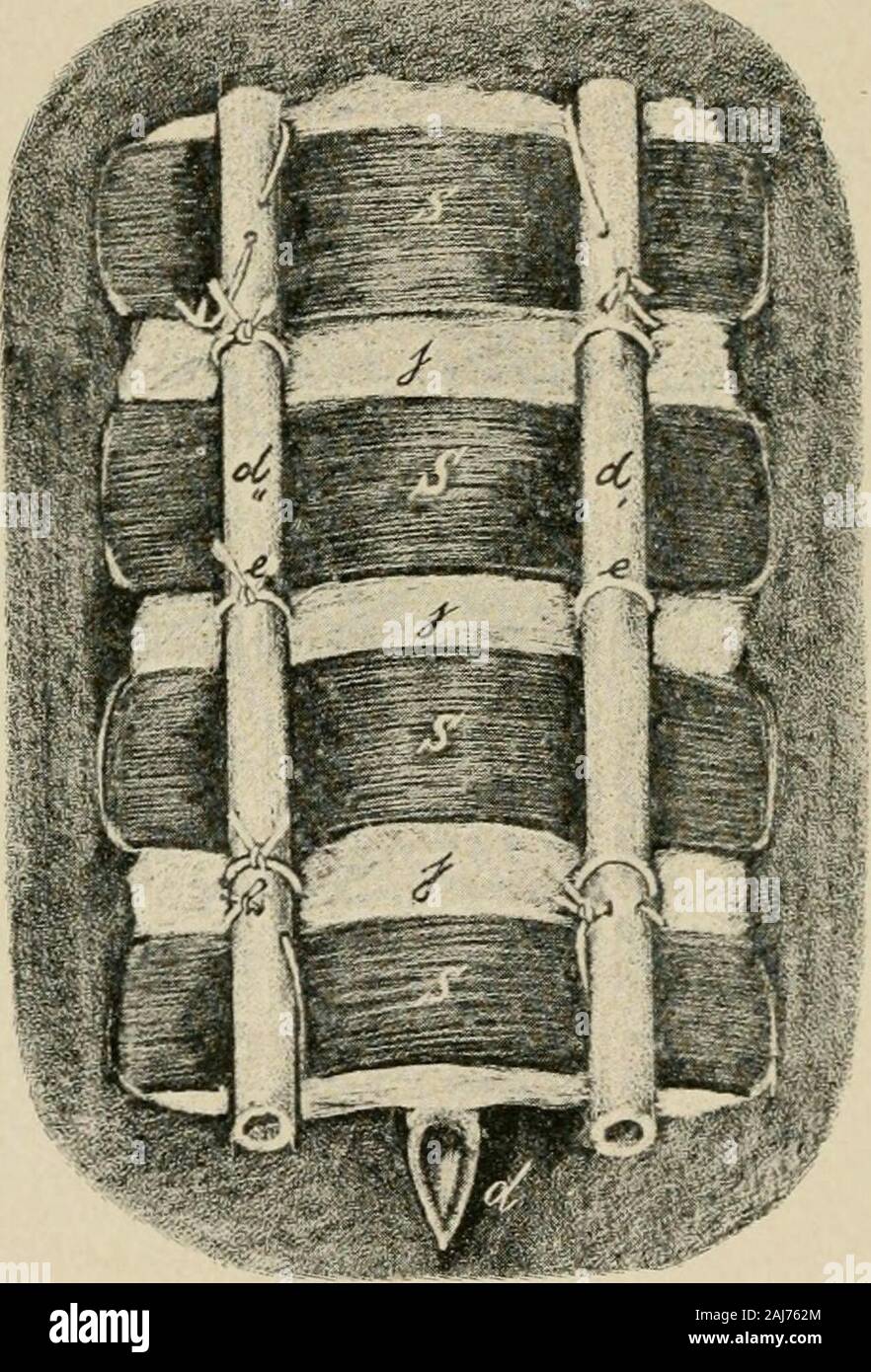 Surgical and obstetrical operations . Fig. 13 Retention, and Continuous ...