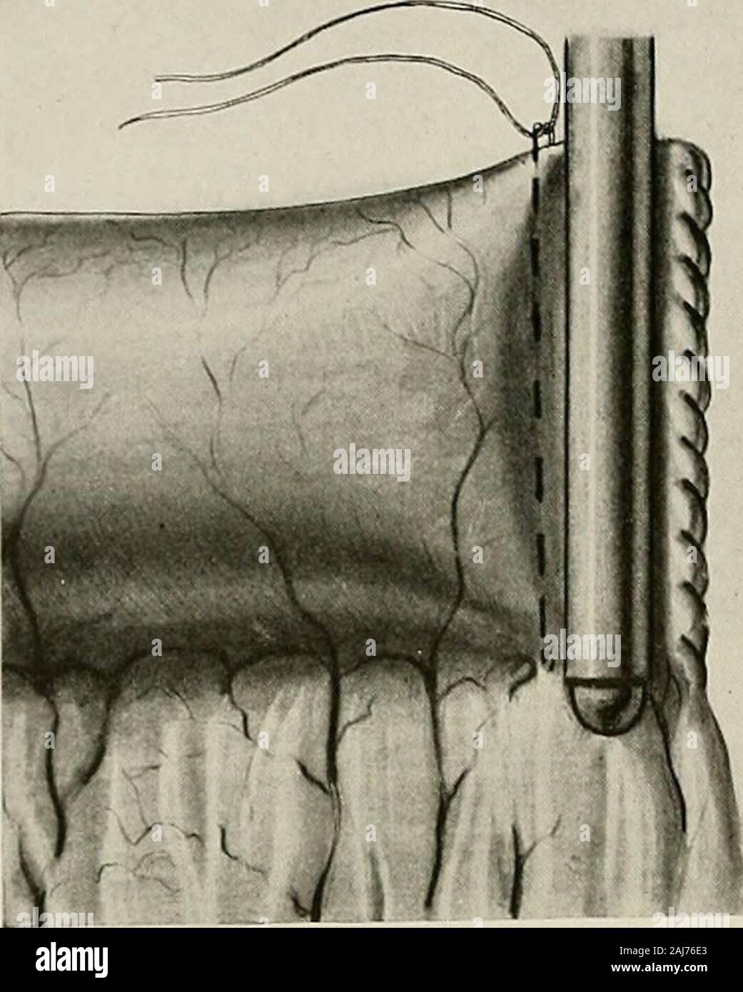 Distal intestine hi-res stock photography and images - Alamy