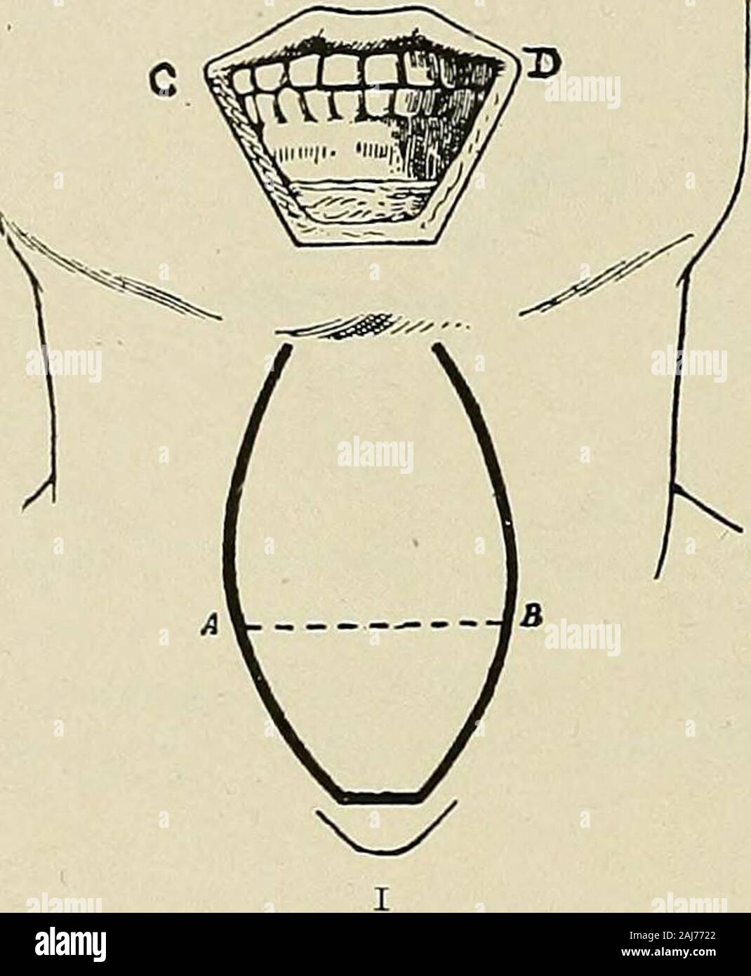 Labial plastic surgery hi-res stock photography and images - Alamy