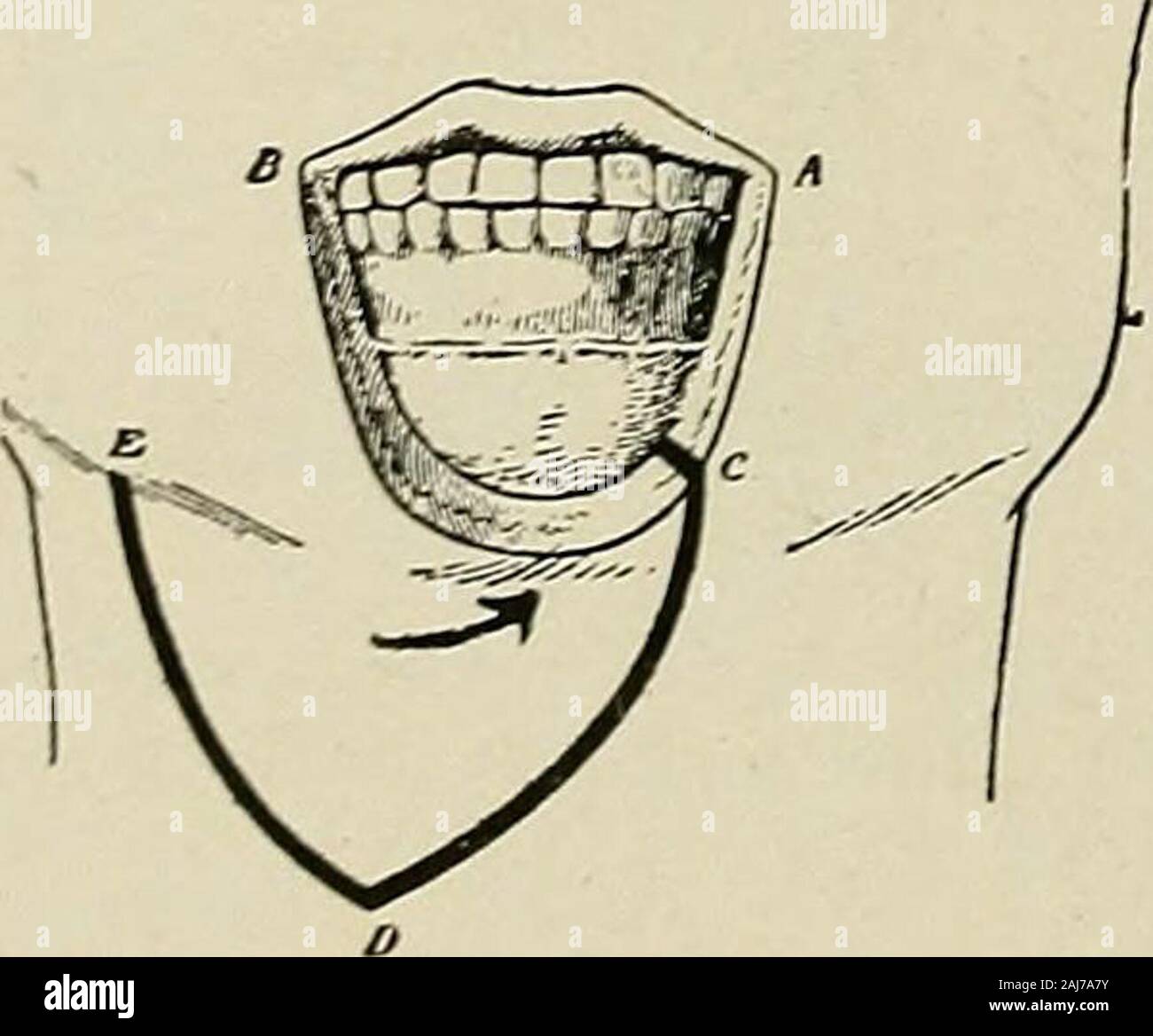 Plastic surgery; its principles and practice . Fig. 594.—Operation for ...