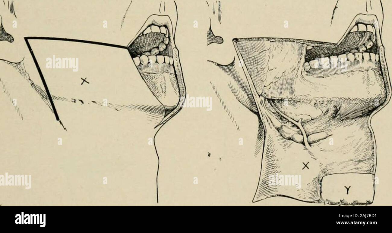Vermilion Border Scar