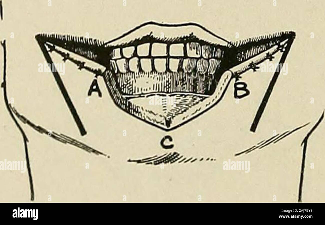 Plastic surgery; its principles and practice . Fig. 591.—Operation for ...