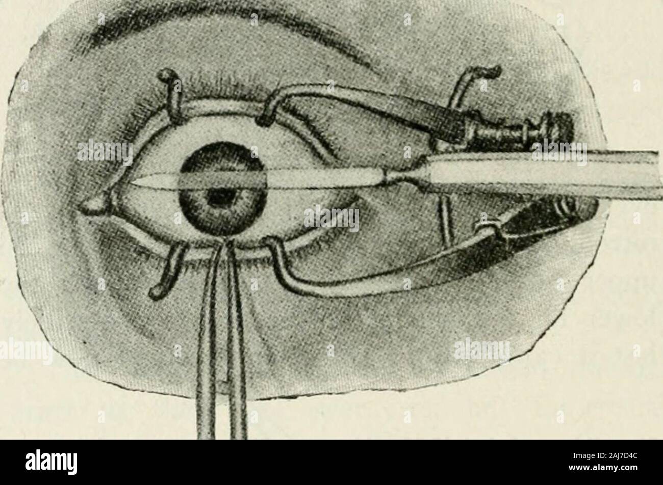 Corneal incision hi-res stock photography and images - Alamy