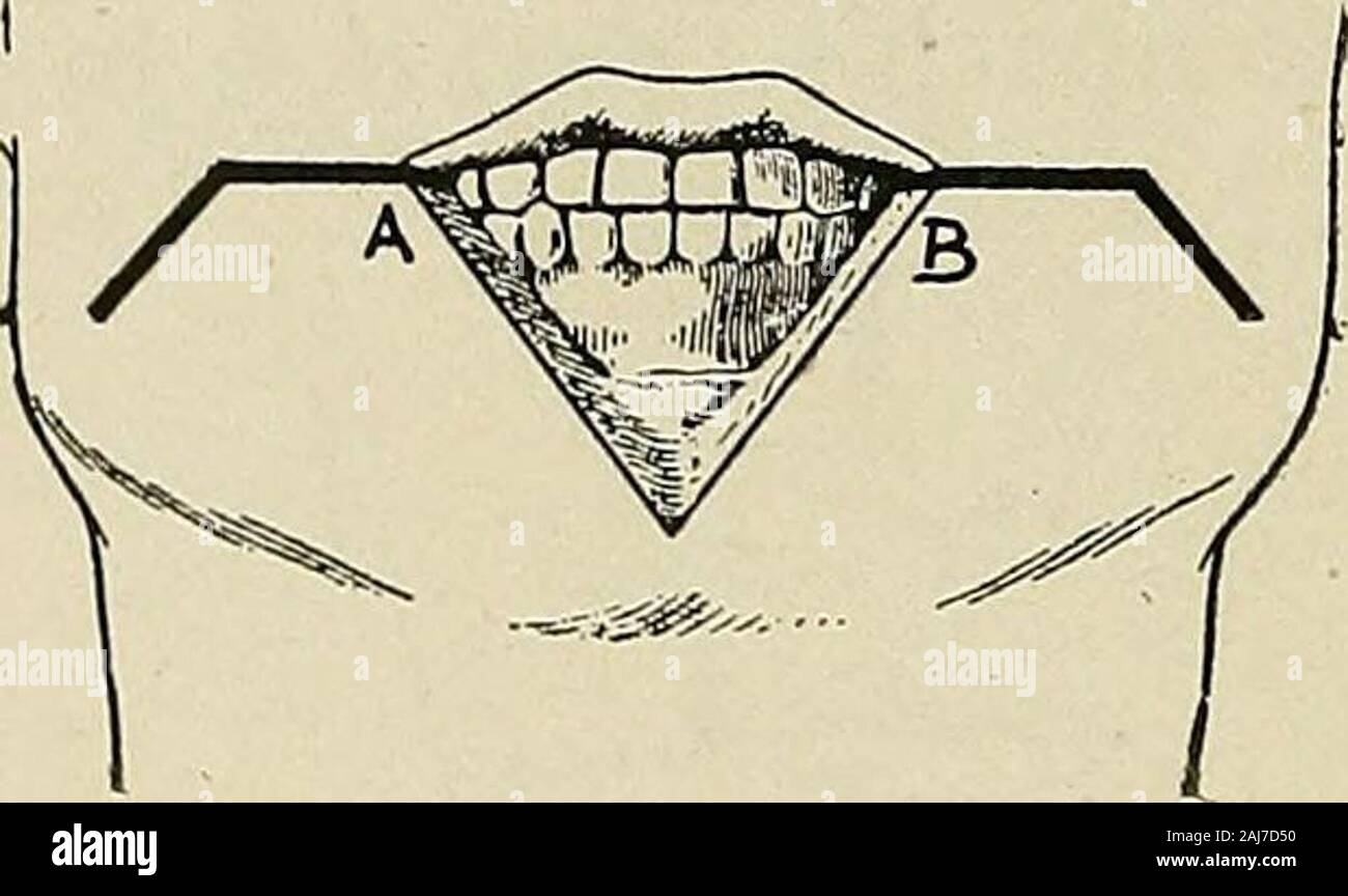 Flap reconstruction hi-res stock photography and images - Alamy