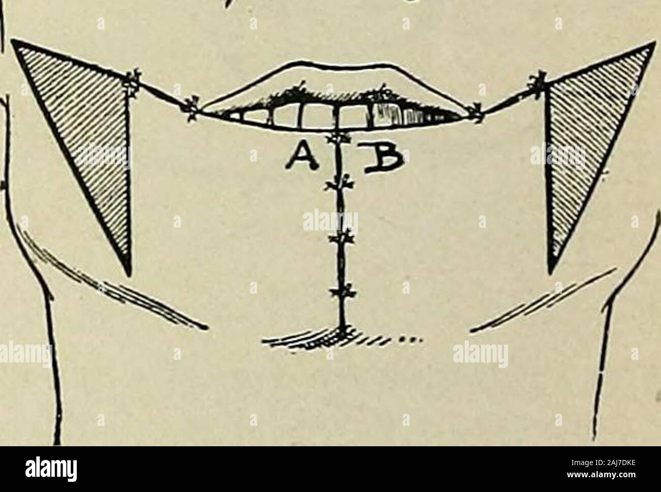 Plastic surgery; its principles and practice . I 2 Fig. 586.—Operation ...