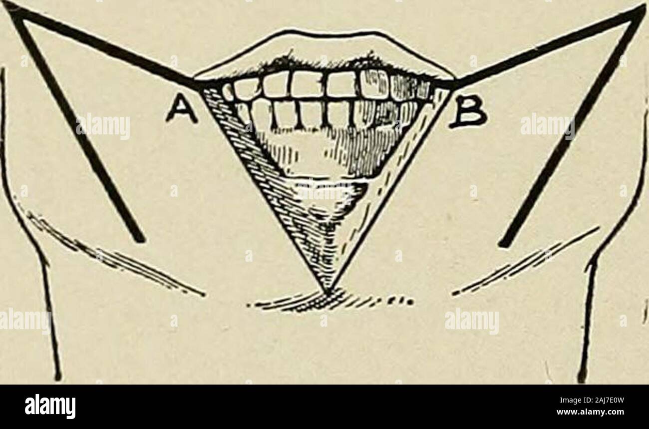 Plastic surgery; its principles and practice . Fig. 585.—Operation for ...