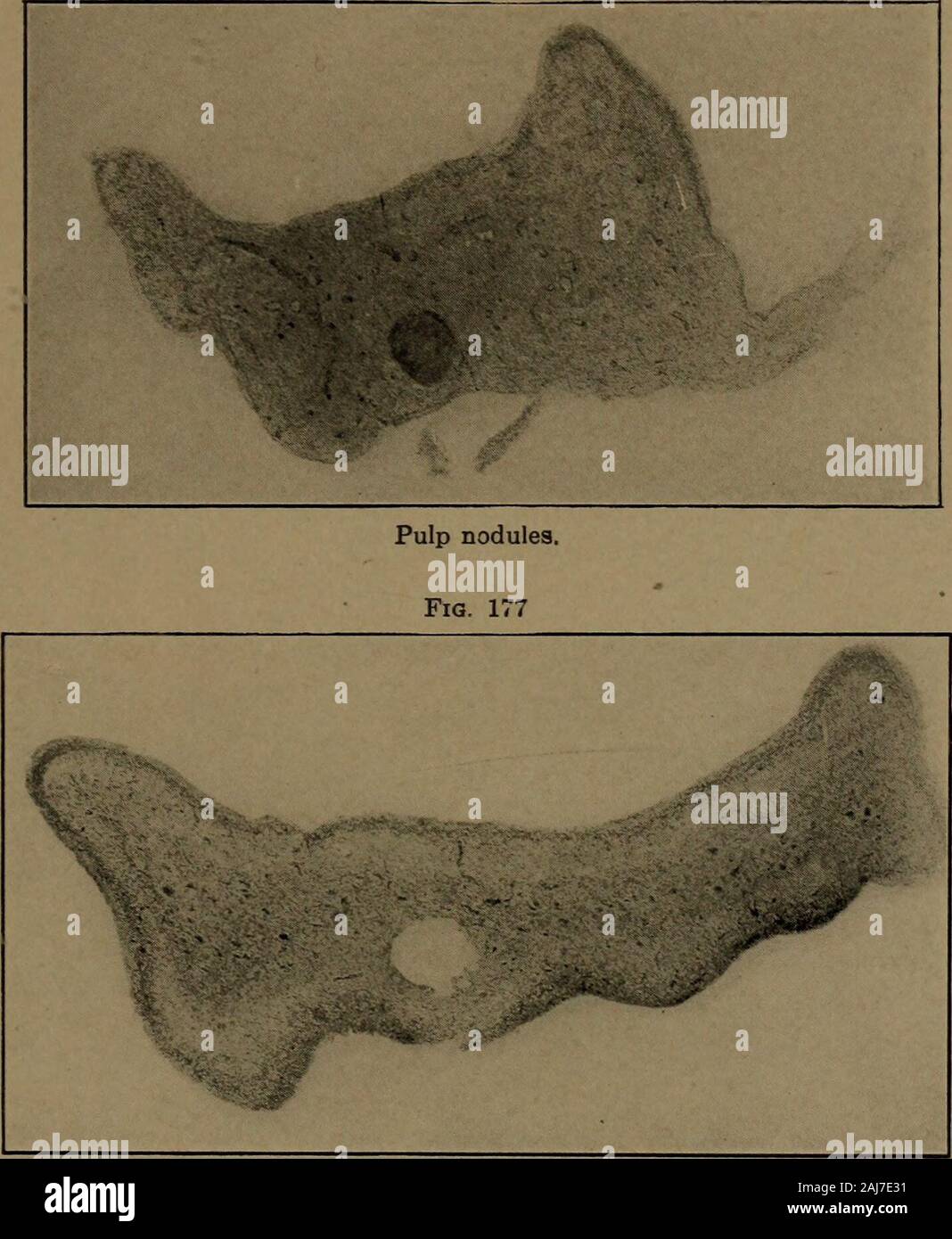 Formation of an abscess hi-res stock photography and images - Alamy