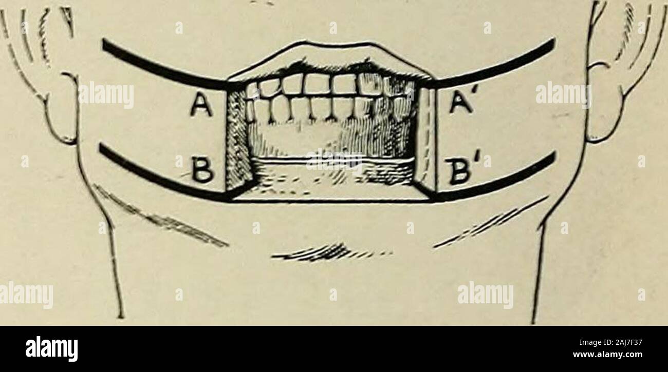 Plastic surgery; its principles and practice . Fig. 578. Fig. 579. Fig ...
