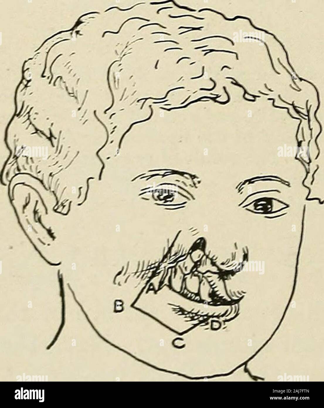 Plastic surgery; its principles and practice . Fig. 570.—Operation for ...