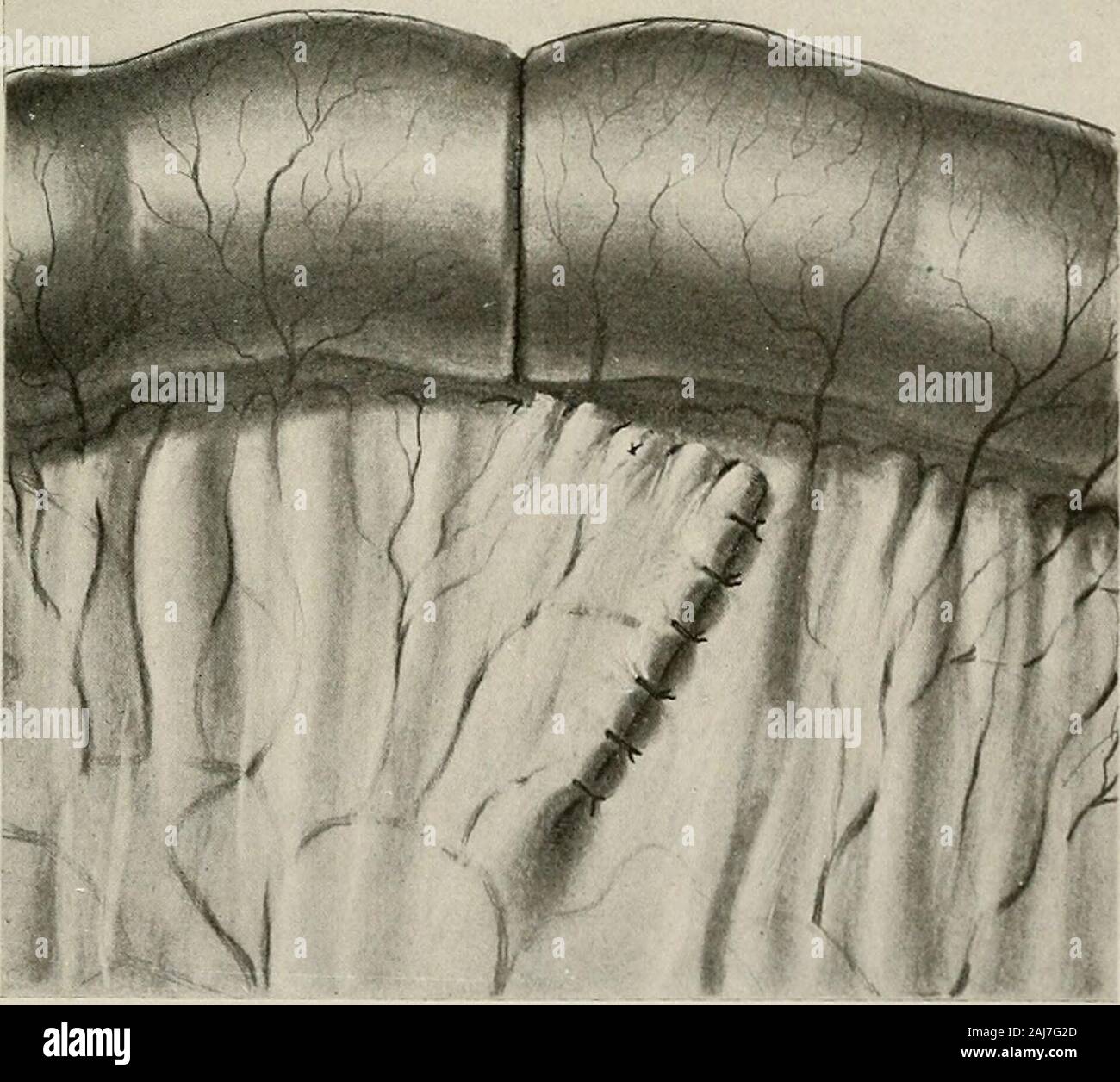 Bowel resection hi-res stock photography and images - Alamy