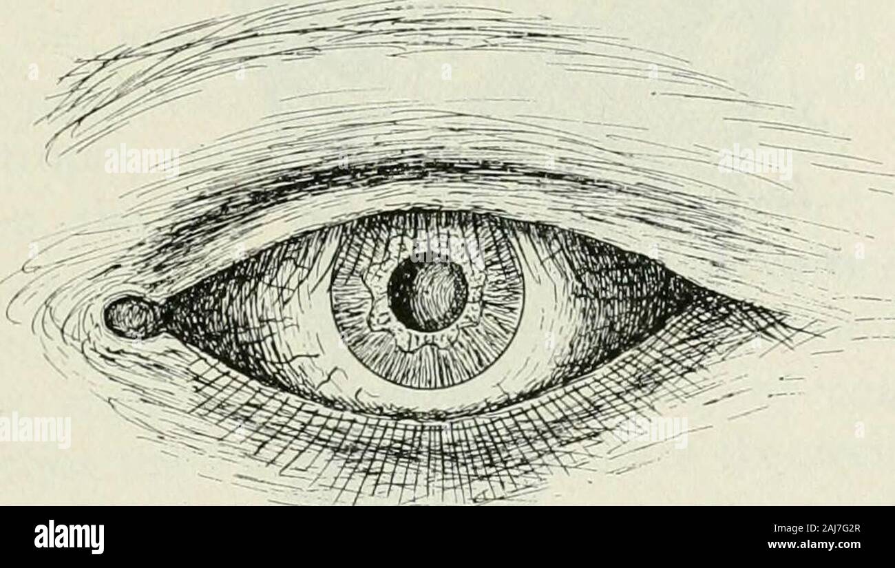 Dislocation lens hi-res stock photography and images - Alamy