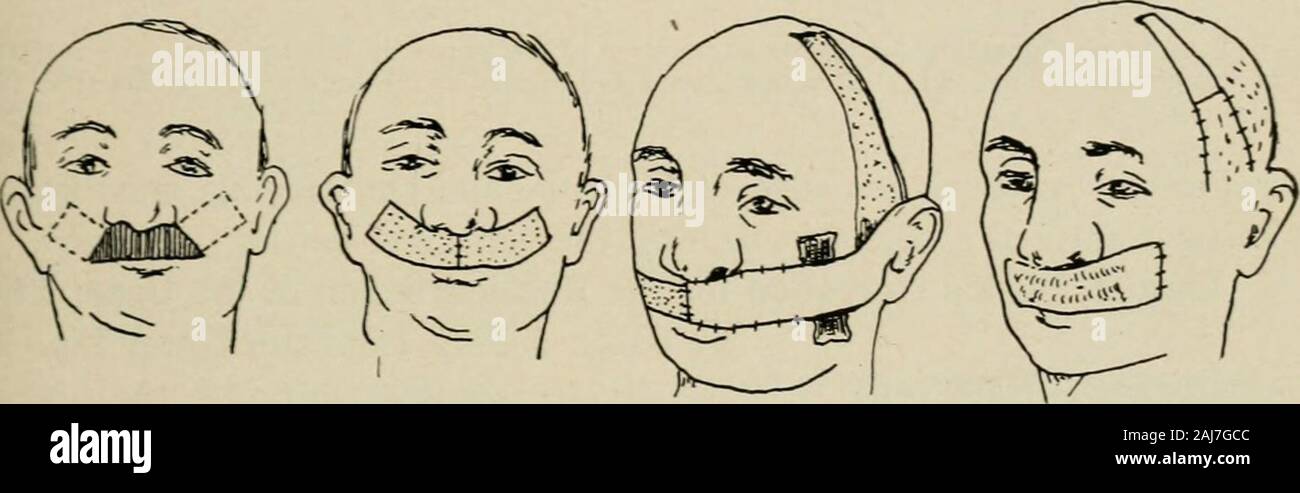 Plastic surgery; its principles and practice . SURGERY OF THE LIPS 517 ...