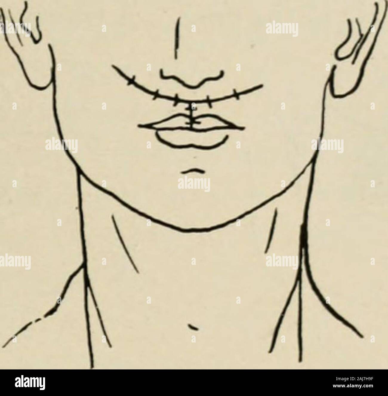 Transverse facial hi-res stock photography and images - Alamy