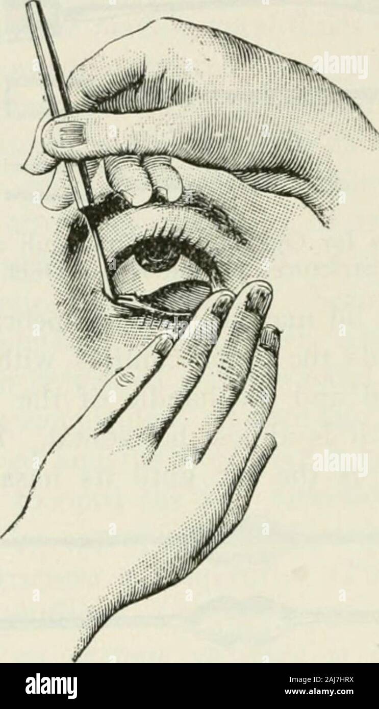 The commoner diseases of the eye : how to detect and how to treat them ...