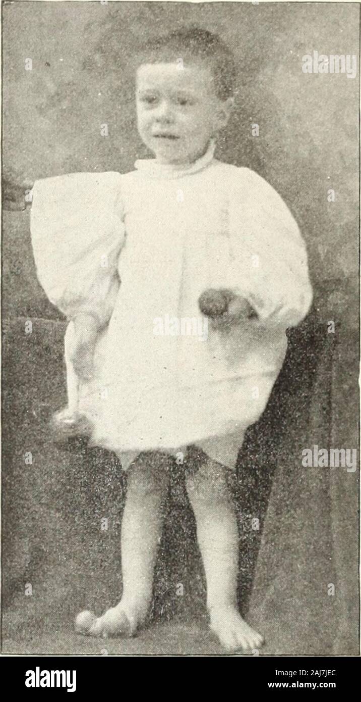 Rickets child hi-res stock photography and images - Alamy