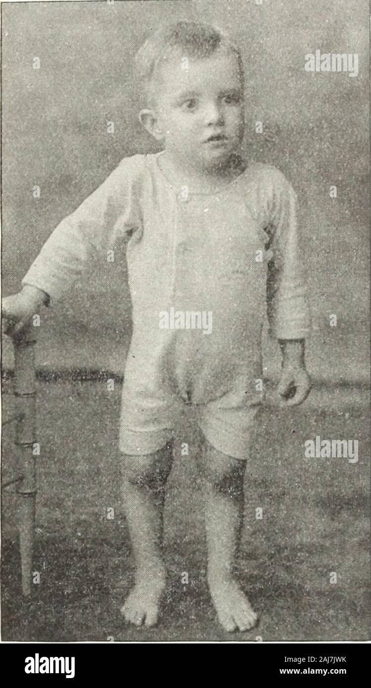 Rickets child hi-res stock photography and images - Alamy