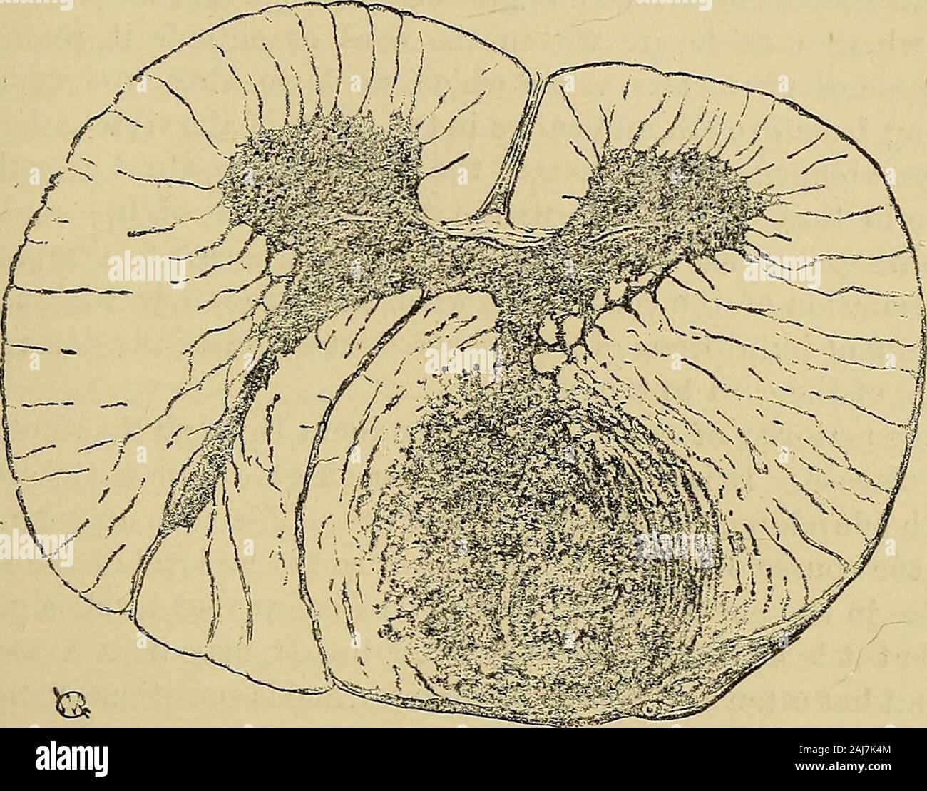 A manual of diseases of the nervous system . TUMOUES. 549 is shown in ...