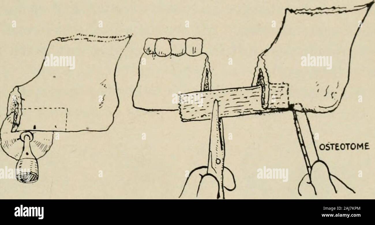 Osteotome hi-res stock photography and images - Alamy