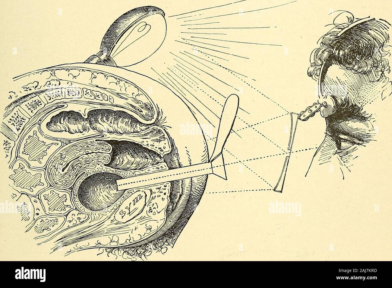 Operative gynecology : . Fig. 223.—Holding the Vesical Speculum ready ...