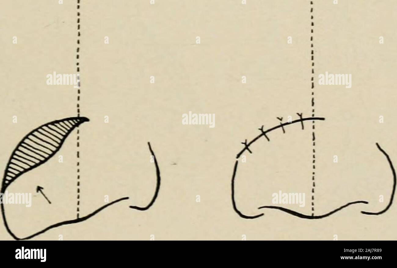 Midline incision hi-res stock photography and images - Alamy