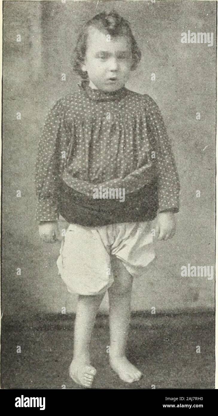 Talipes Varus High Resolution Stock Photography and Images - Alamy