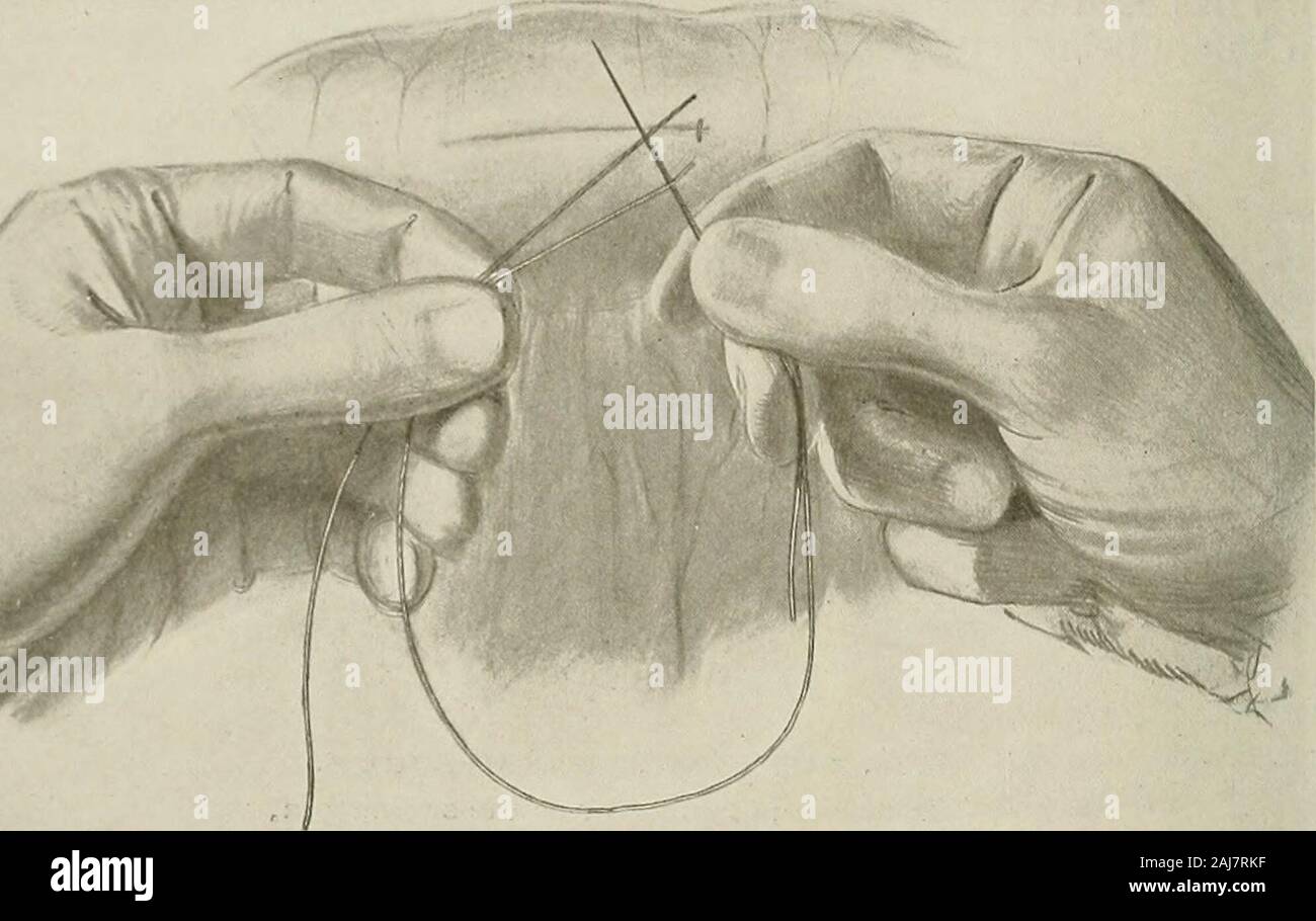 Sutures infected hi-res stock photography and images - Alamy