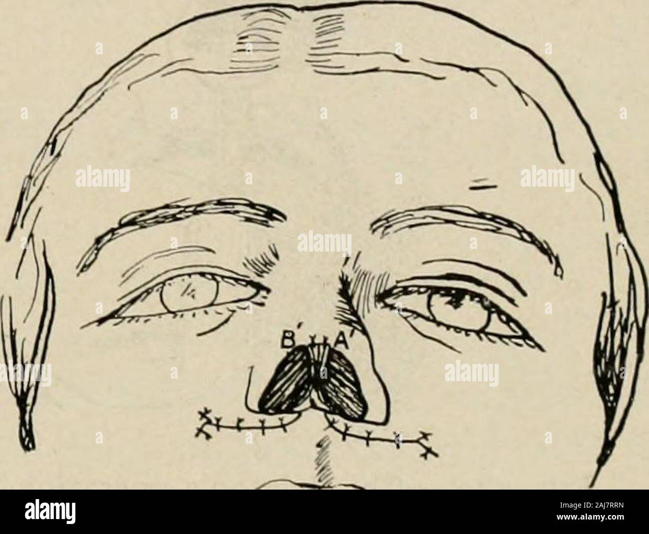 Plastic surgery; its principles and practice . wi^^^^. /^^^^ Fig. 529 ...