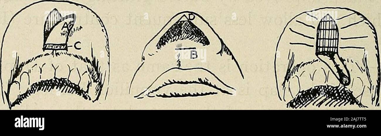 Septum damage hi-res stock photography and images - Alamy