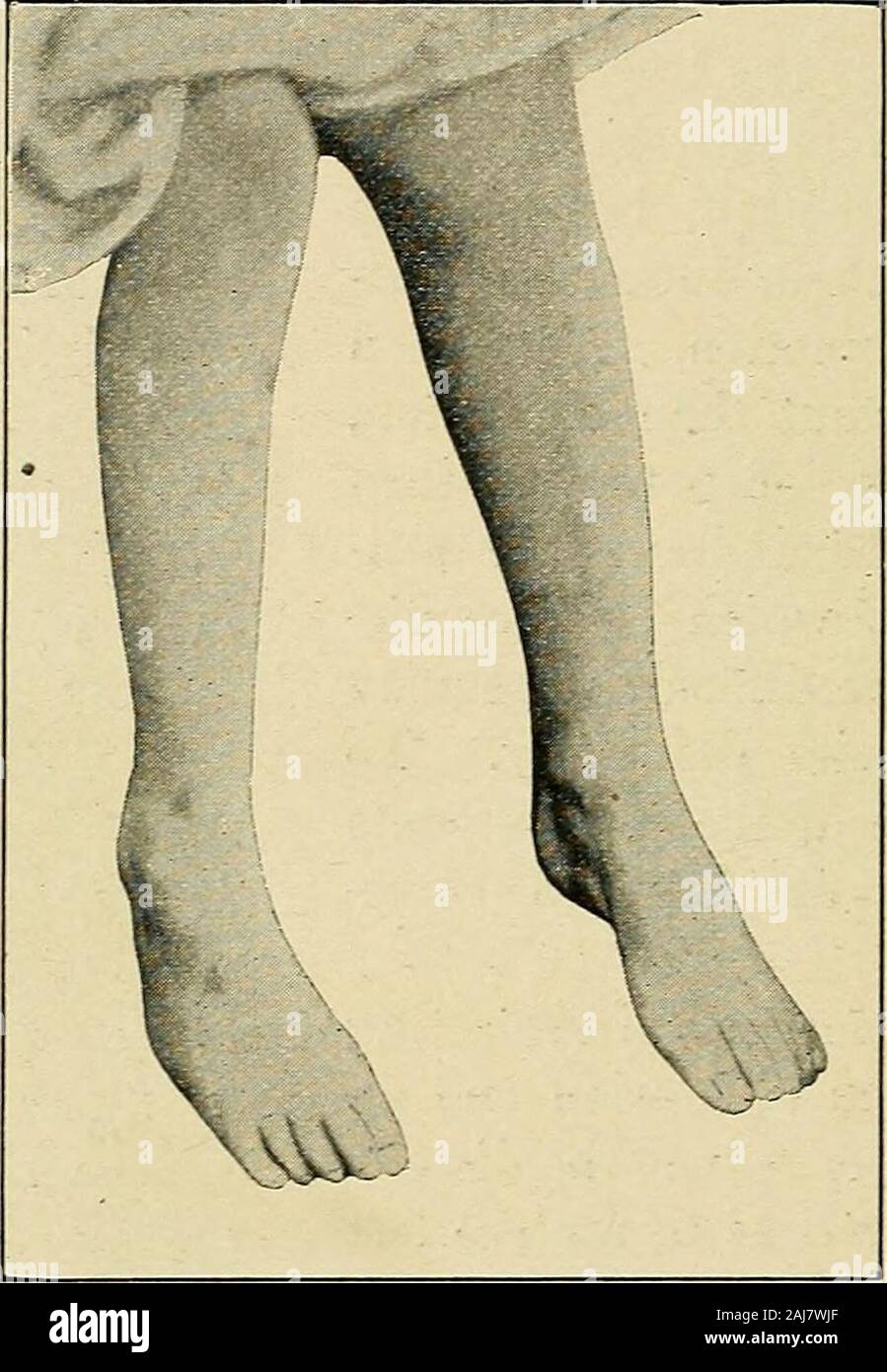 Abduction Of Foot