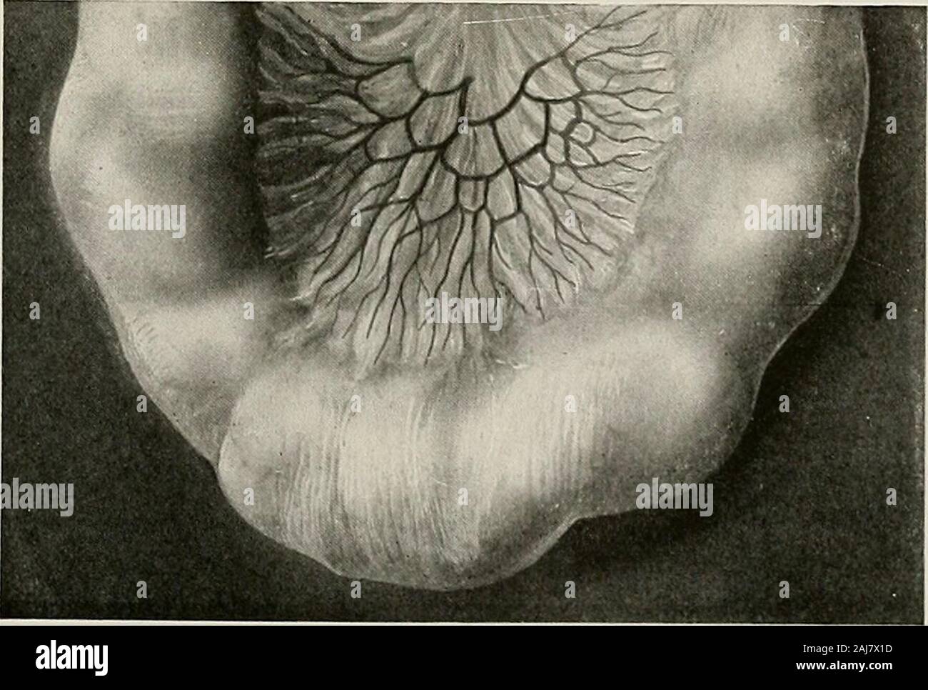 Loops of small intestine hi-res stock photography and images - Alamy
