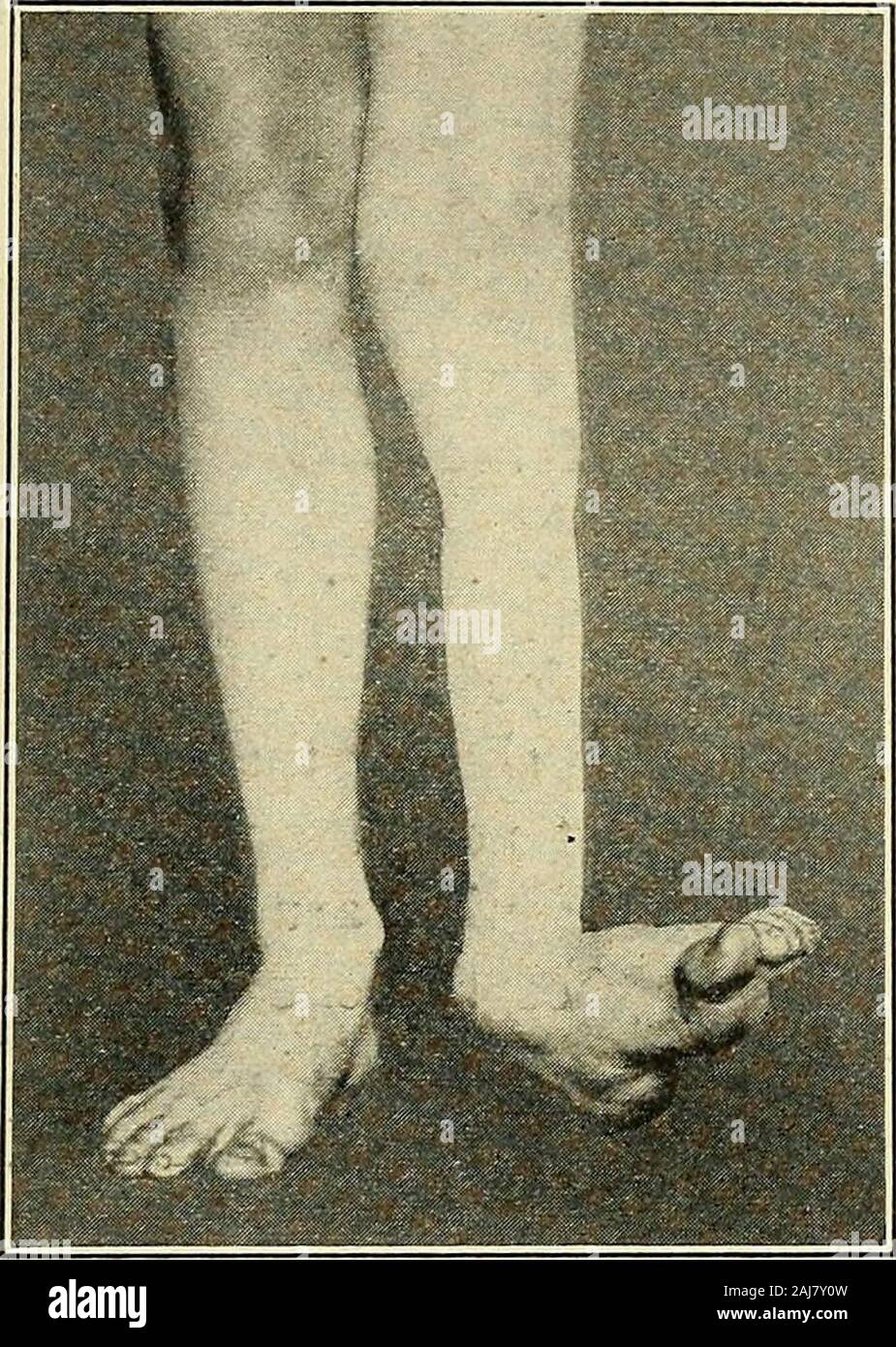 Calcaneovalgus hi-res stock photography and images - Alamy