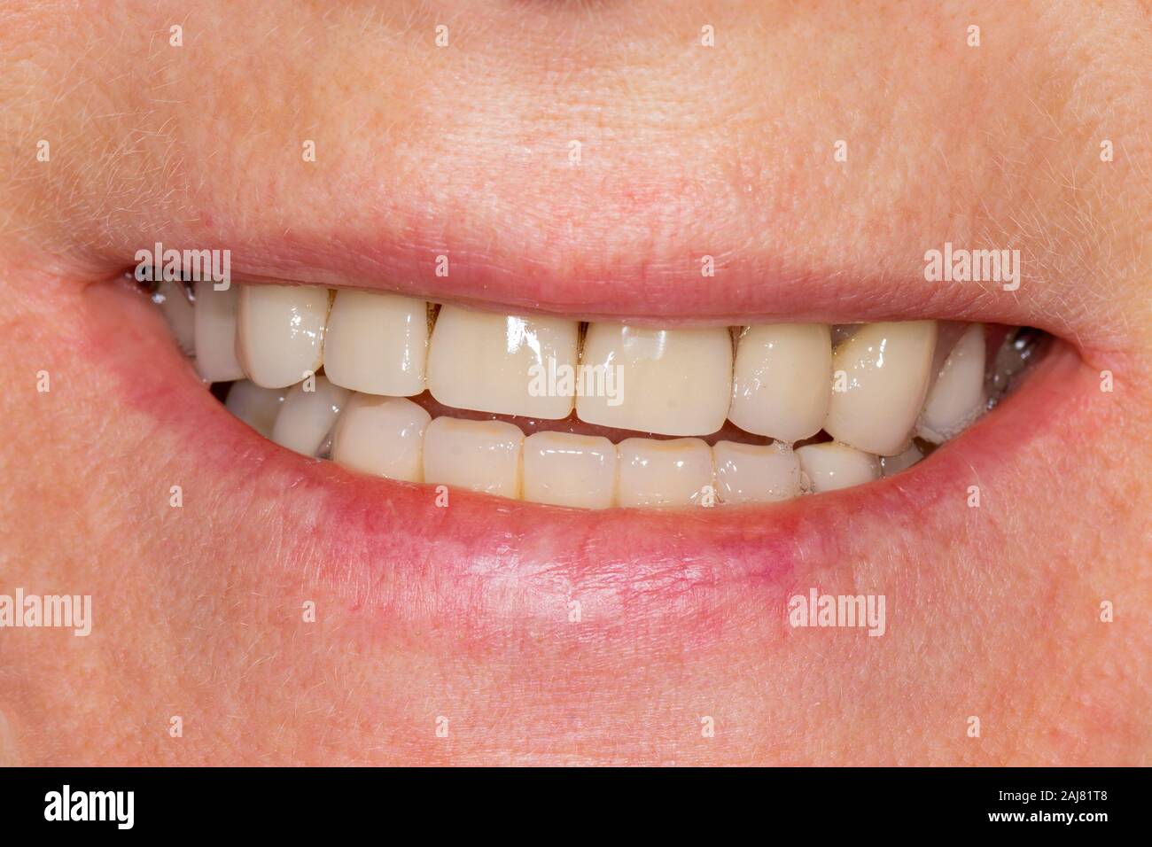 two chewing side teeth of the upper jaw after treatment of caries ...