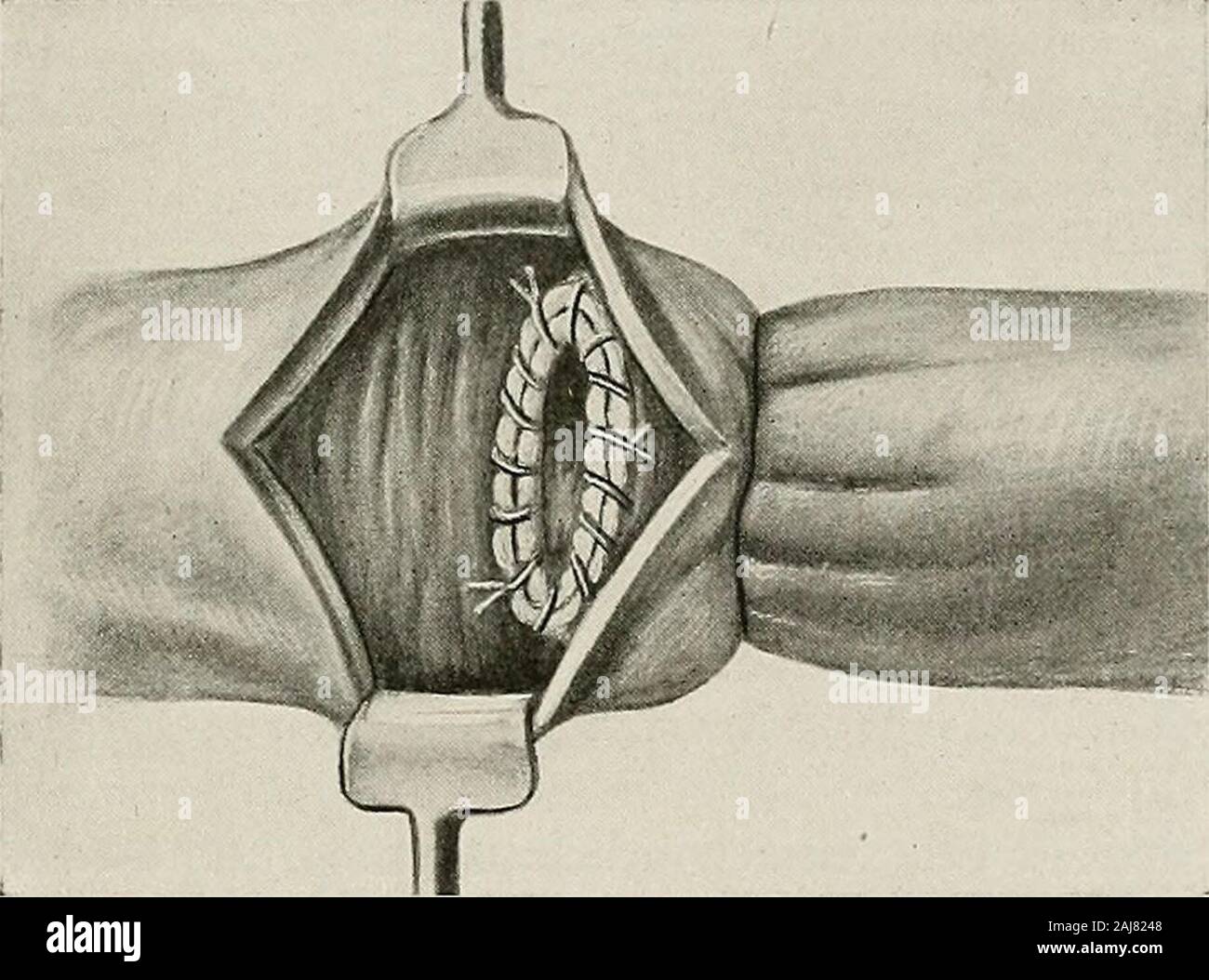 Intussusception hi-res stock photography and images - Alamy