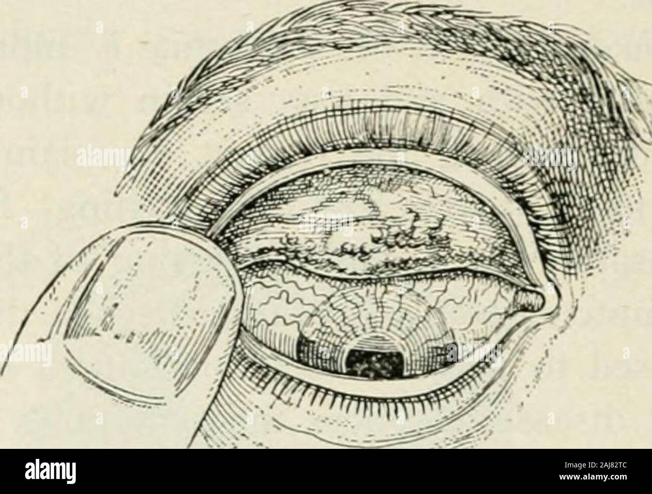 Conjunctival degeneration hi-res stock photography and images - Alamy