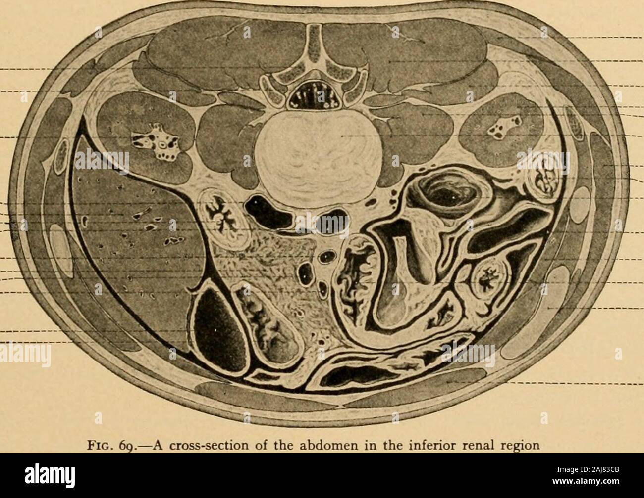 Kidney abscess hi-res stock photography and images - Alamy