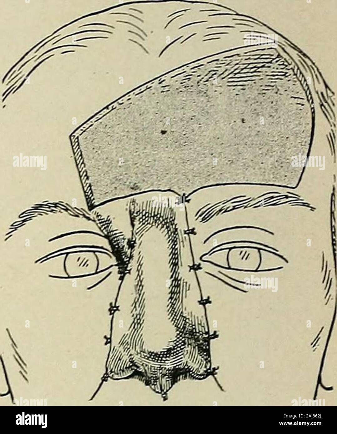 Plastic surgery; its principles and practice . Fig. 491.—Operation for ...