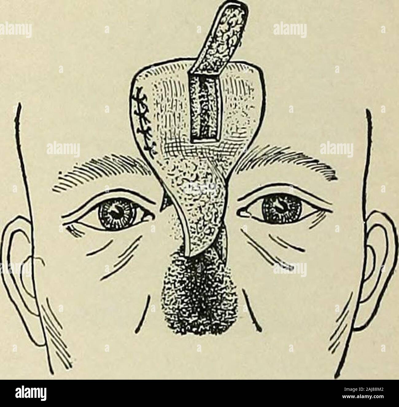 Midline incision hi-res stock photography and images - Alamy