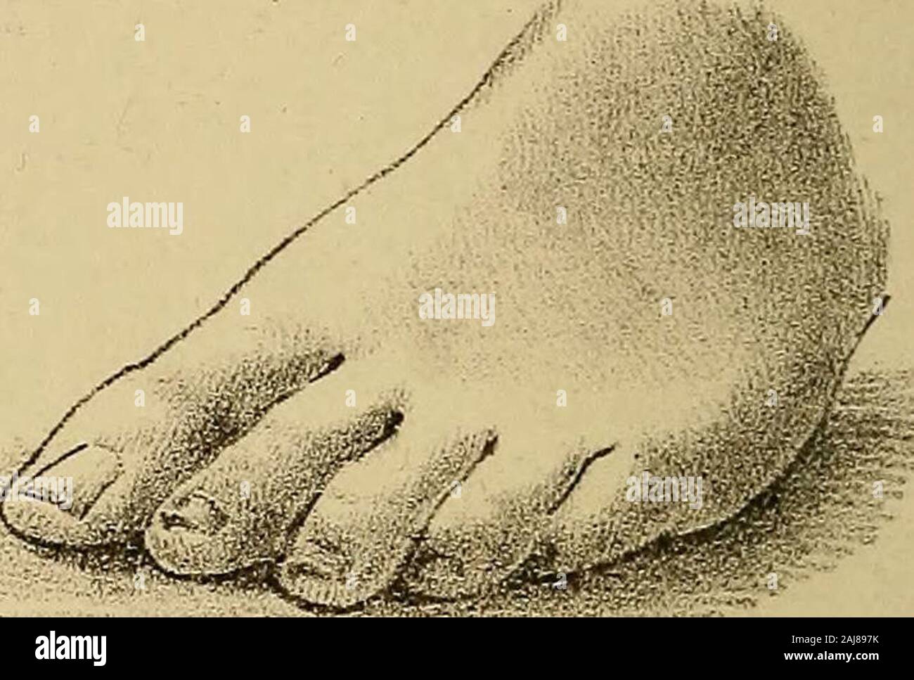 On contractions of the fingers (Dupuytren's and congenital contractions ...