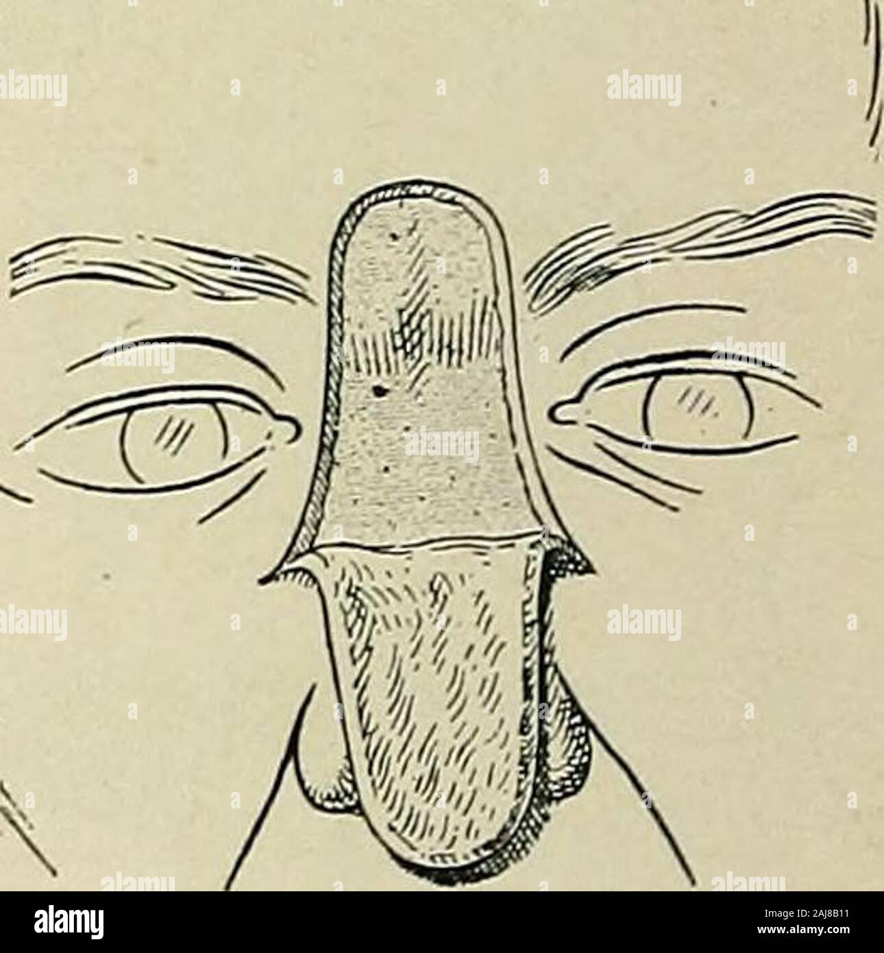 Plastic surgery; its principles and practice . Pig. 480.—Operation for ...