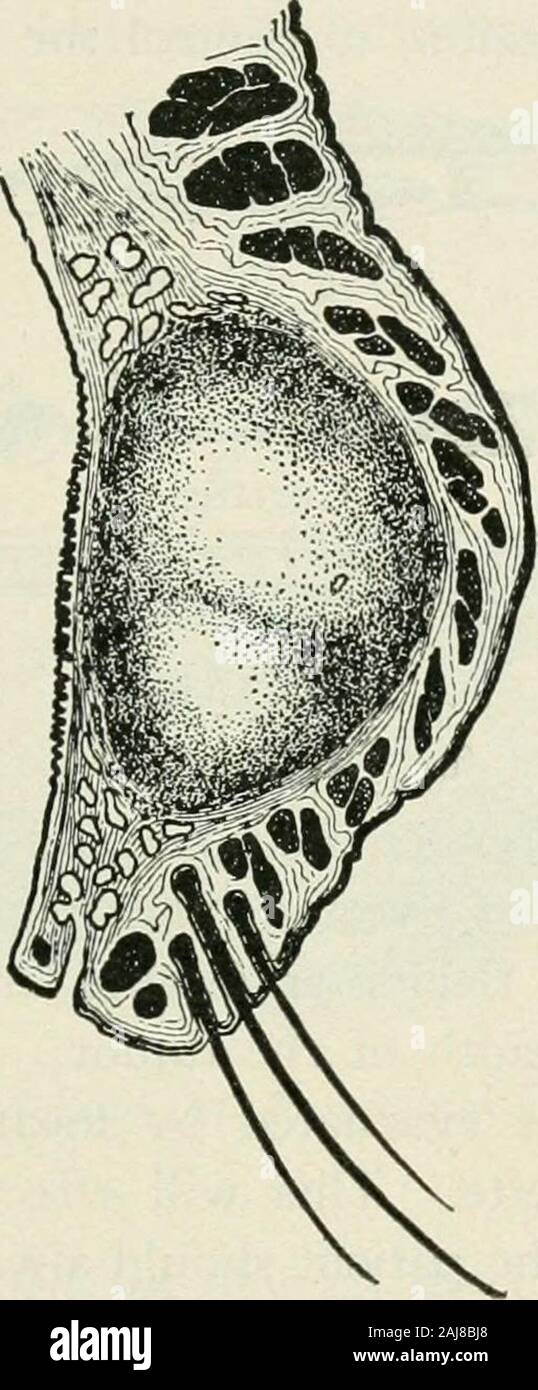 Meibomian cyst hi-res stock photography and images - Alamy