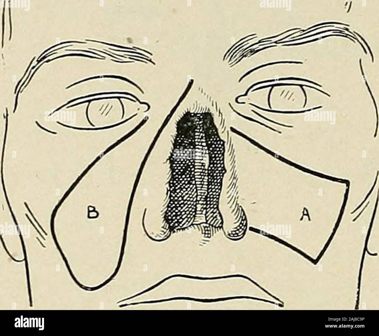 Walter Yeo Skin Graft